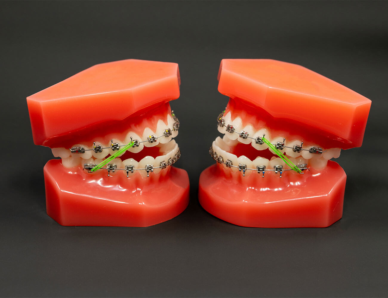 Elastic Wear - Smiles Forever Orthodontics | Dacula Duluth Flowery ...