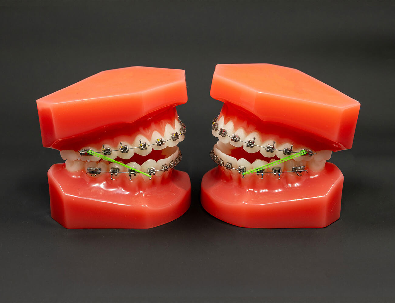 Elastic Wear - Smiles Forever Orthodontics | Dacula Duluth Flowery ...