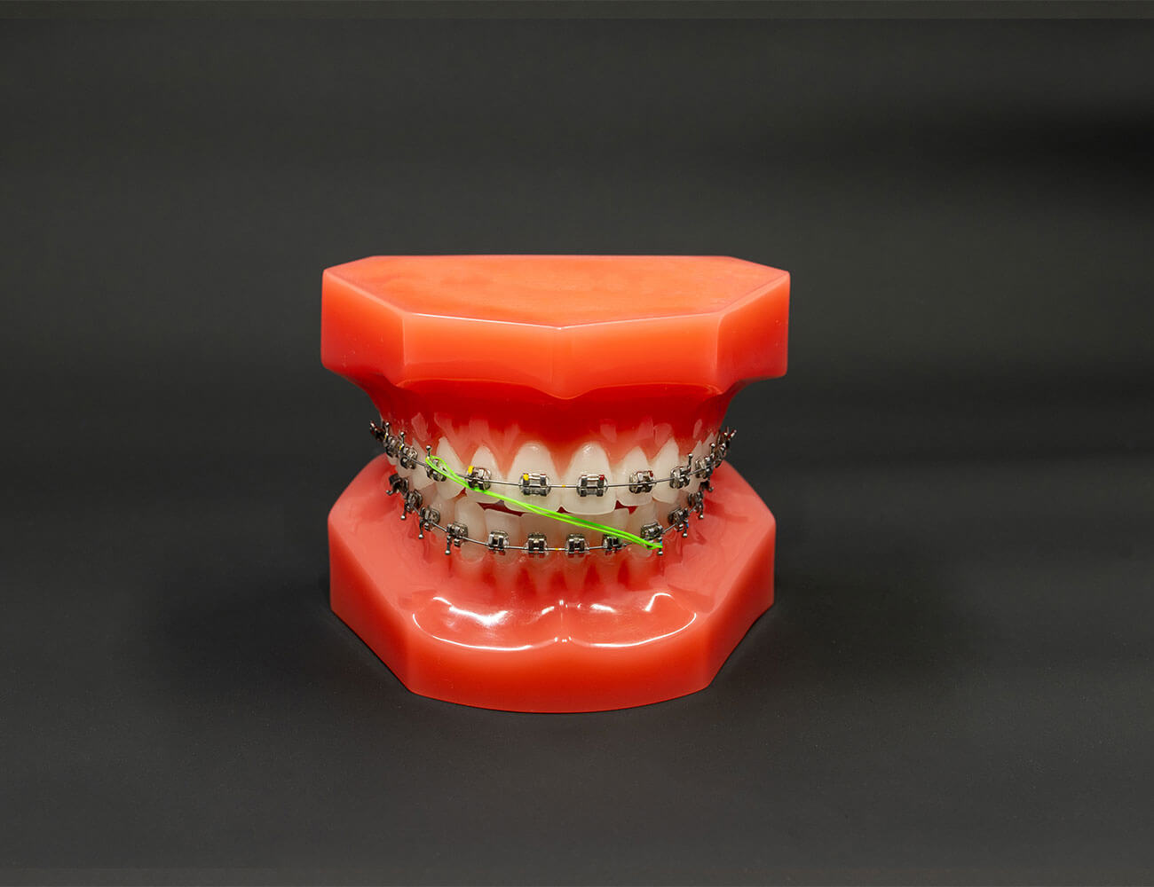 Elastic Wear - Smiles Forever Orthodontics | Dacula Duluth Flowery ...