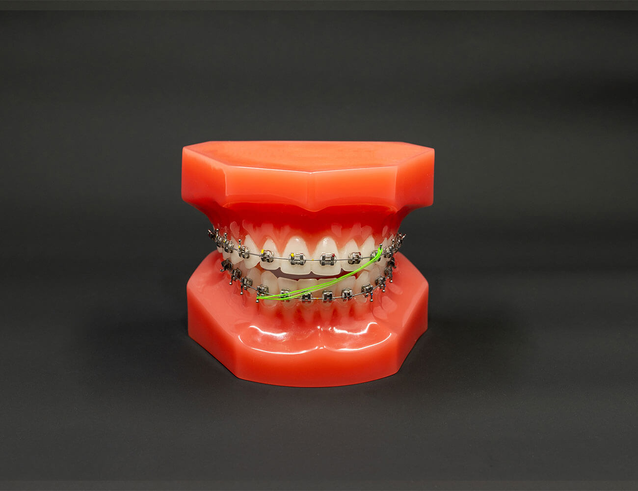 Elastic Wear - Smiles Forever Orthodontics | Dacula Duluth Flowery ...