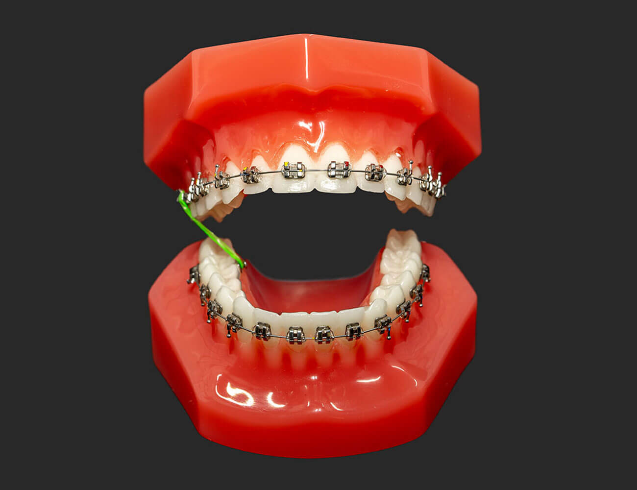 Elastic Wear - Smiles Forever Orthodontics | Dacula Duluth Flowery ...