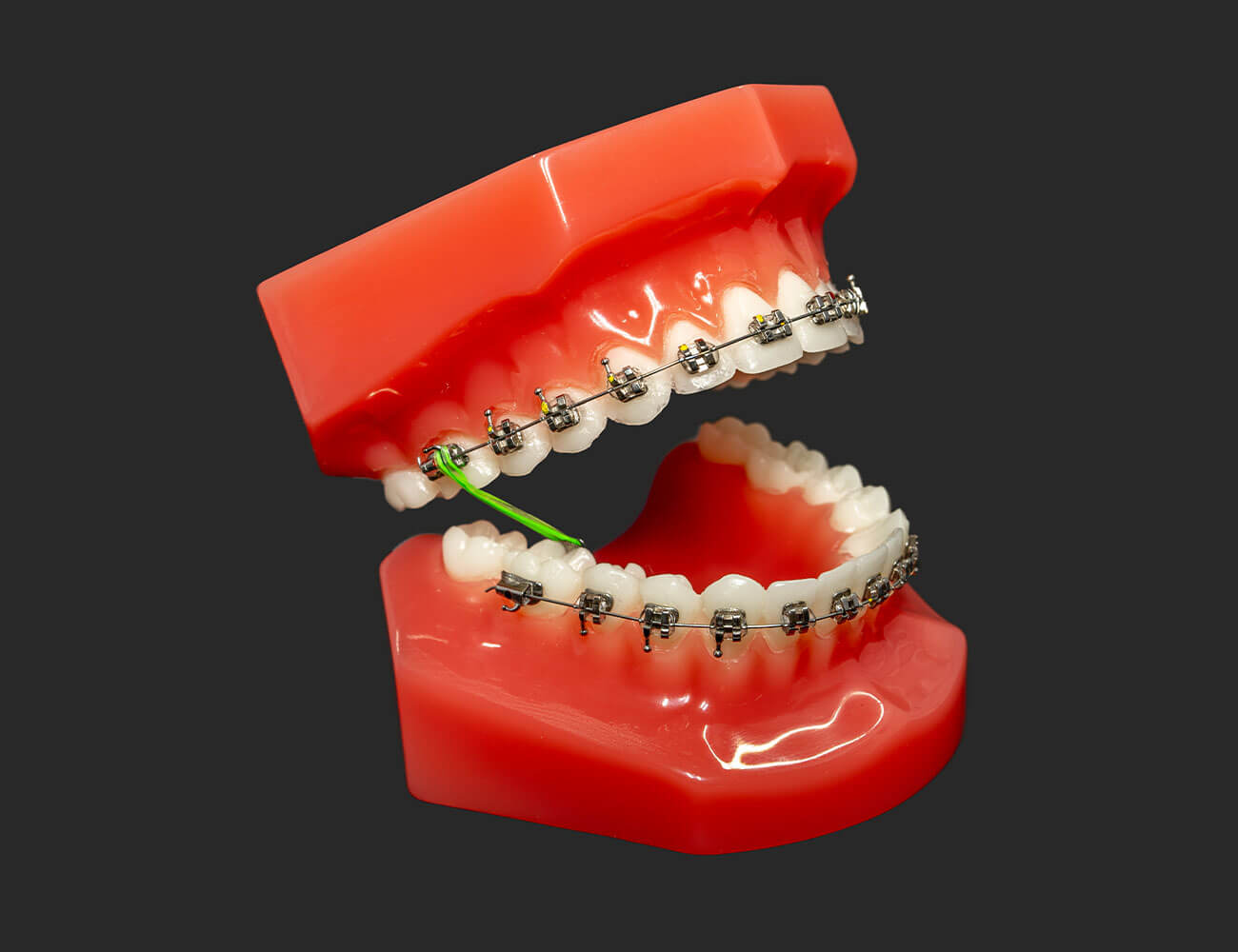 Elastic Wear - Smiles Forever Orthodontics | Dacula Duluth Flowery ...