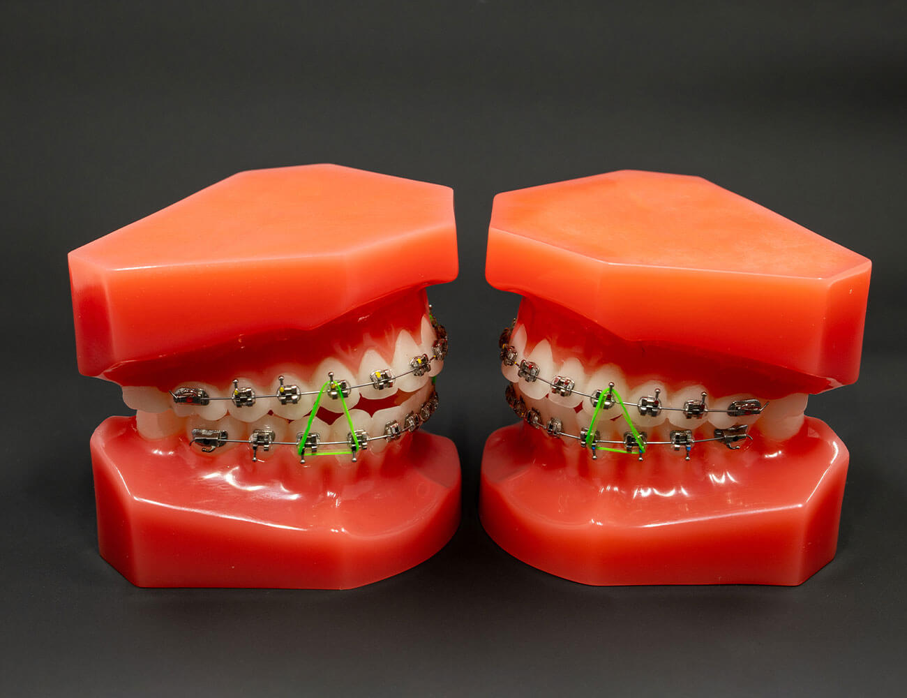 Elastic Wear - Smiles Forever Orthodontics | Dacula Duluth Flowery ...